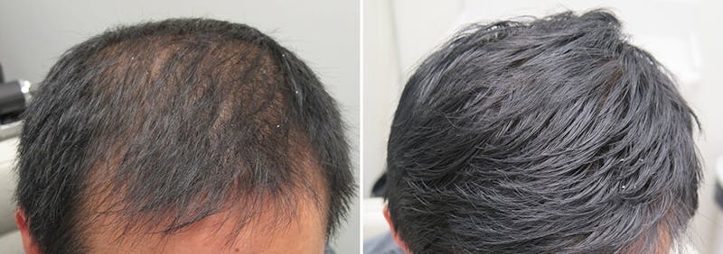 Finasteride Before and After Photos [2022]